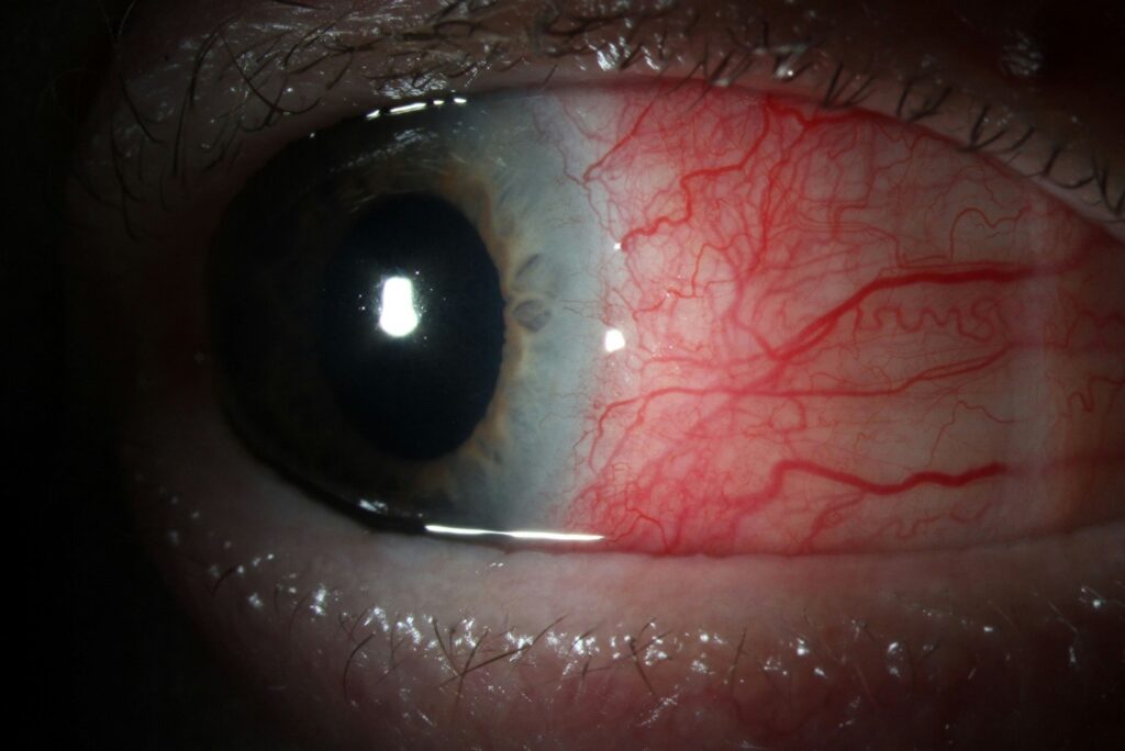 Uveitis and Ocular Inflammation - eyekath.com
